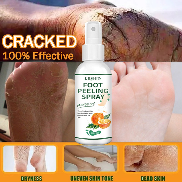 New 10ml/20ml/30ml/50ml Anti Fungal Infections Foot Spray for Athlete's ...