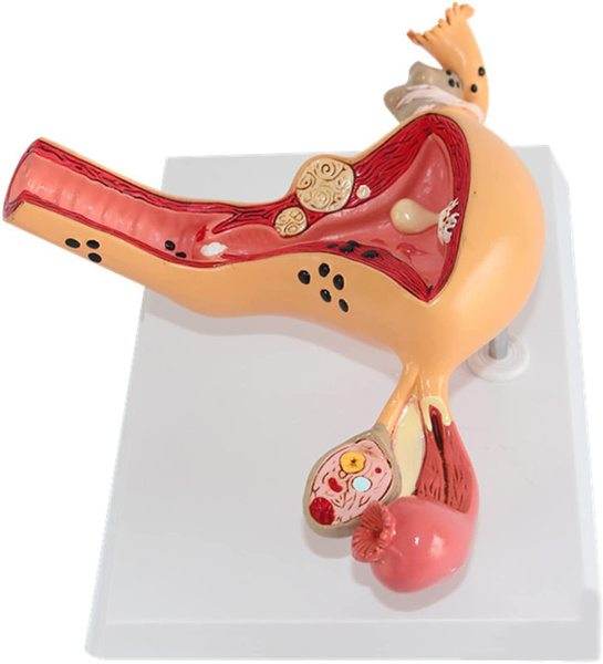 Female Pathological Uterus Ovary Anatomical Model Anatomy Cross-Section ... Female Pathological Uterus Ovary Anatomical Model Anatomy Cross-Section ...