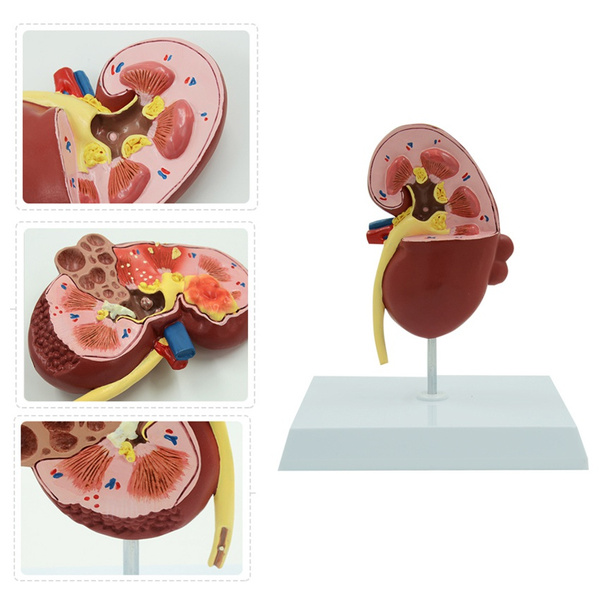 LifeSize Human Anatomical Kidney Disease Model Urology Nephron ...