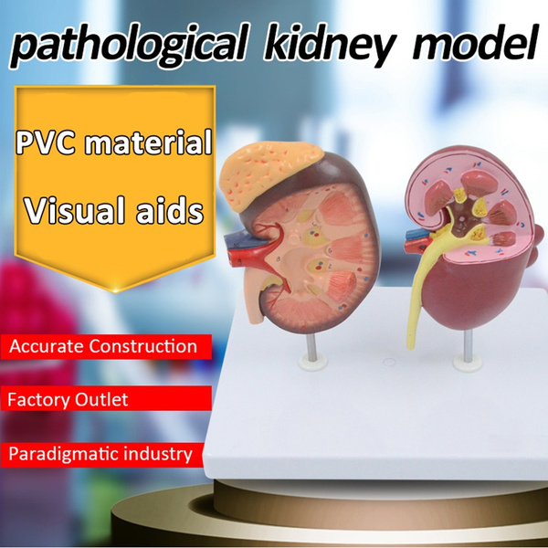 Normal And Sick Kidney Model Urinary Tract Kidney Anatomy Medical ...