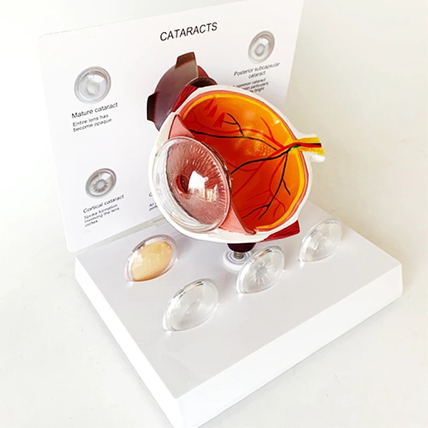Cataract Eye Model Eyeball (Glaucoma) Model Eye Disease Model Eyeball ...
