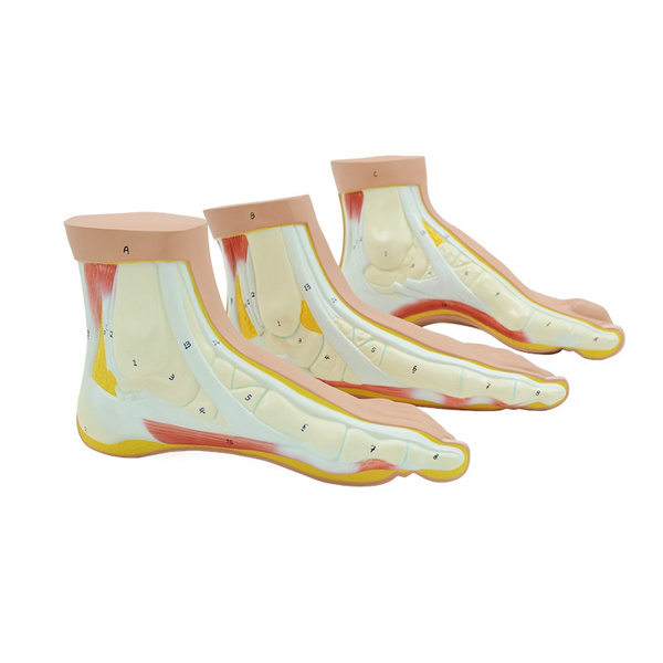 Normal And Abnormal Feet Set Of 3 Flat Foot Curved Foot Model Medical ...
