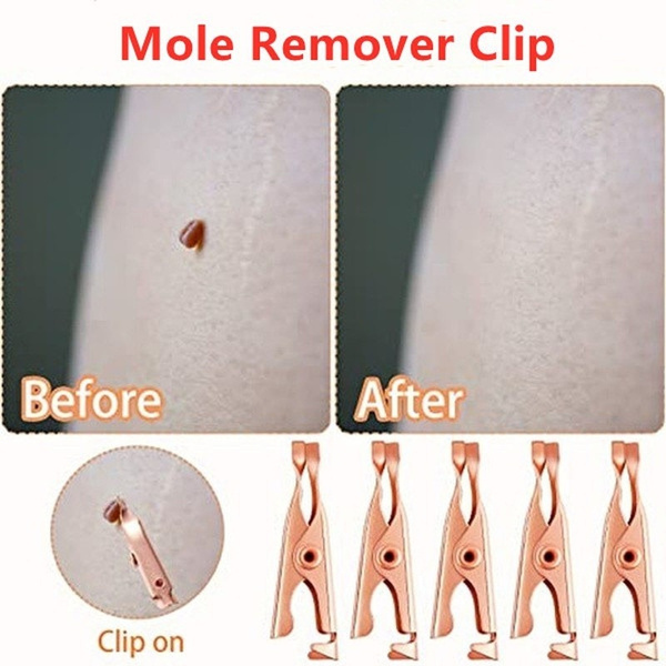1/2Pcs Fashion Skin Tags Remover Wart Tattoo Clip Blackhead Skin ...