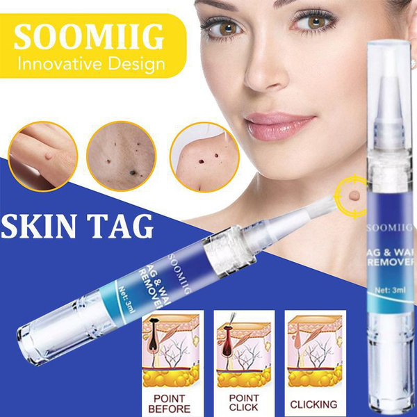 Genital Wart Removal Treatment Papilloma Skin Tag Removal, Mole Remover ...