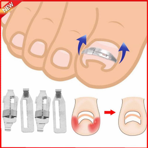 Ingrown Toenail Correction Stainless Steel Toenail Corrector Pedicure ...
