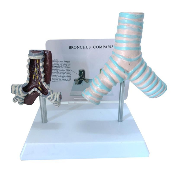 Human Smoking Trachea Versus Healthy Trachea Model Pathological ...