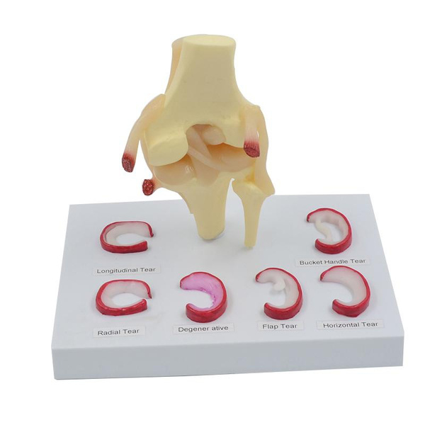 Life Size Knee Joint and Ligament Display Model Meniscus Tear Medical ...