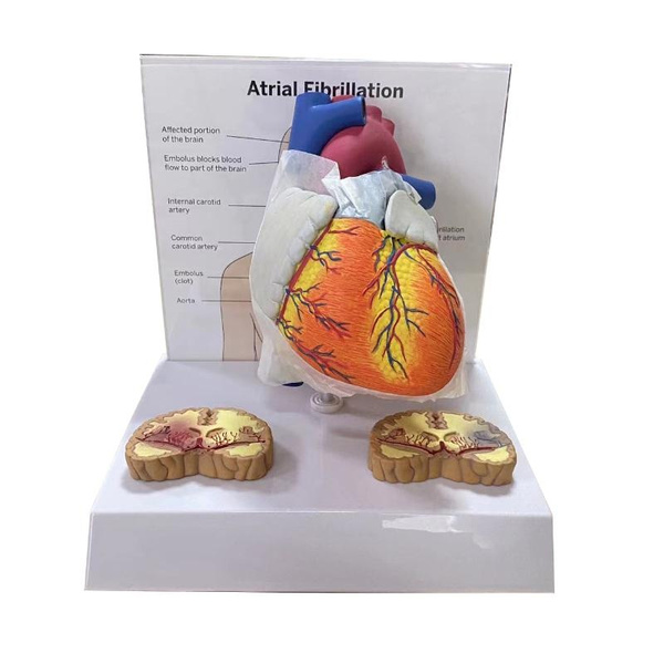 Pvc Levensgroot Atrial Fibrillatie Model Medical Anatomical Models | Wish