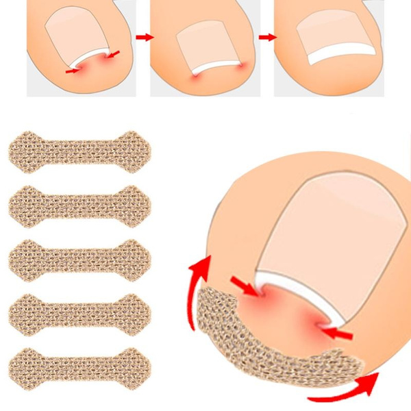 10pcs Ingrown Toenails Band Aid Relief Pain Paronychia Correction ...